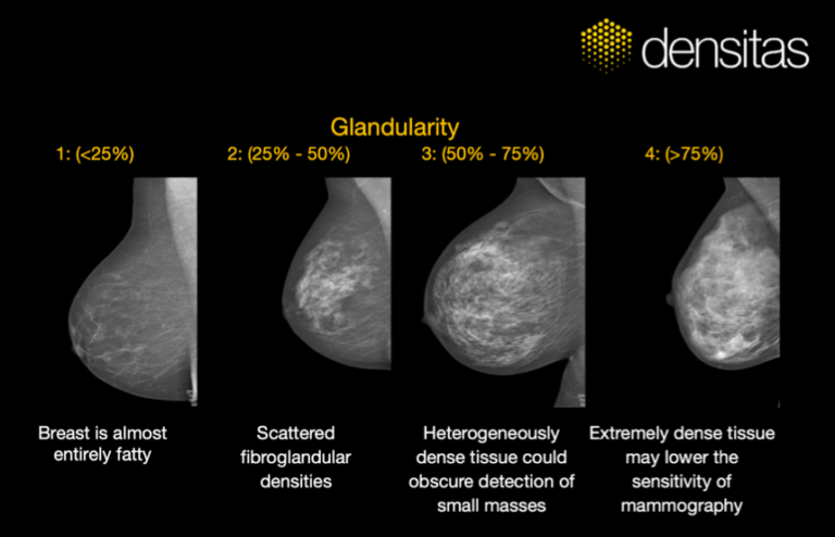 Quantitative assessment does not account for clusters of mammographic ...